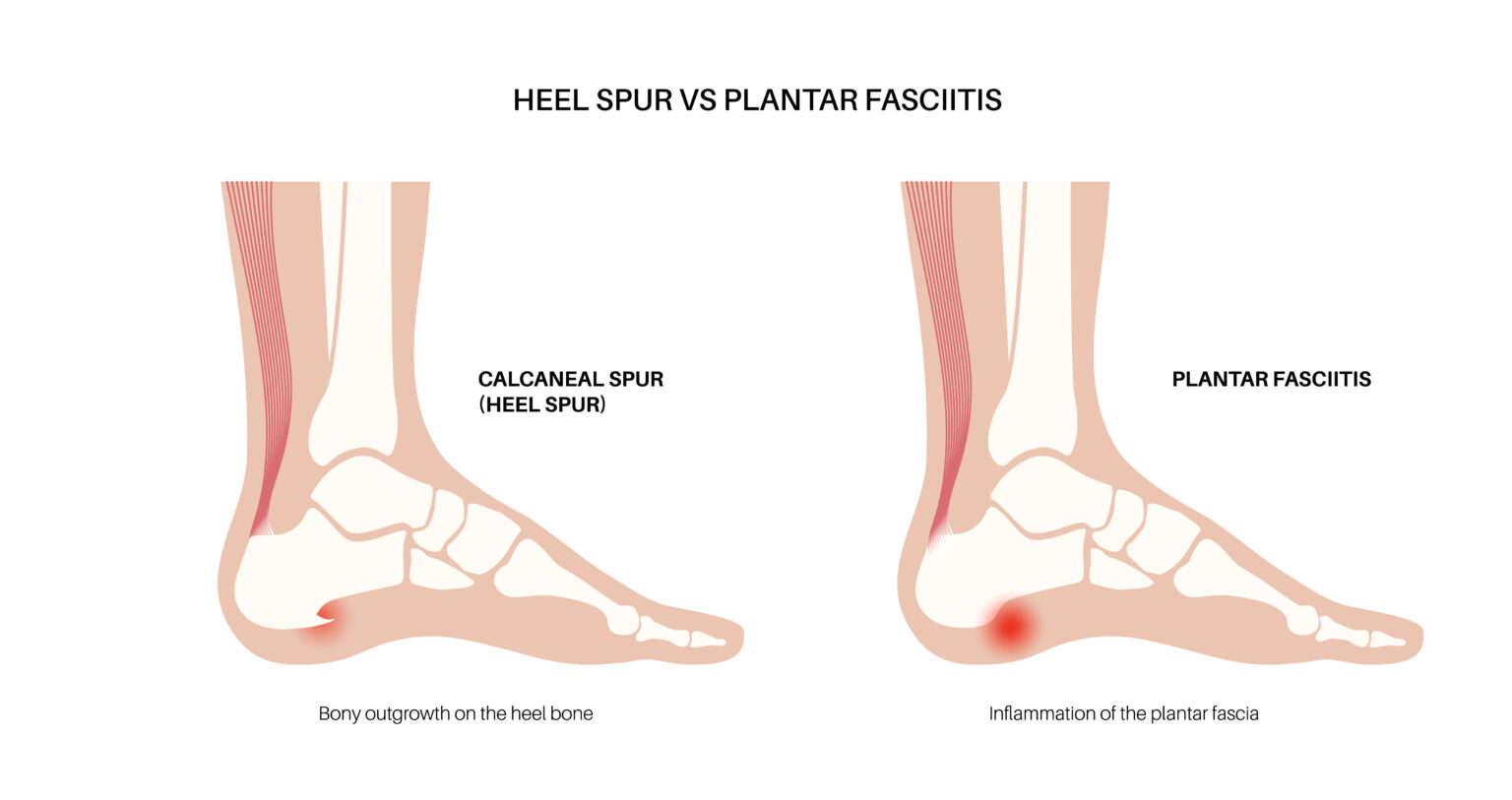 Heel Spur vs. Plantar Fasciitis | Understand the Differences