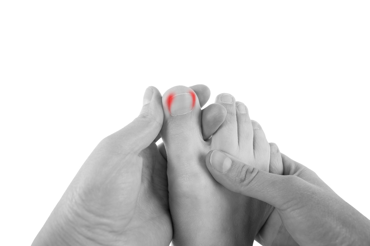 How Ingrown Toenails Trigger Hypergranulation Tissue